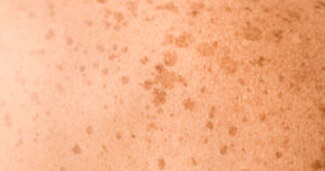 Léntigo solar: qué es, prevención y tratamientos • Instituto ...