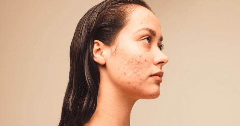 Tipos de granos en la cara: descubre sus causas y cómo tratarlos